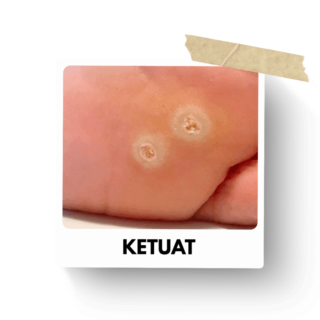 Buang Ketuat, Skin Tag & Cyst Secara Selamat | Poliklinik An-Nur